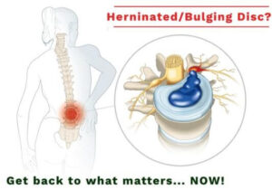 Herniated and Bulging Discs – Crossroads Brain & Spine