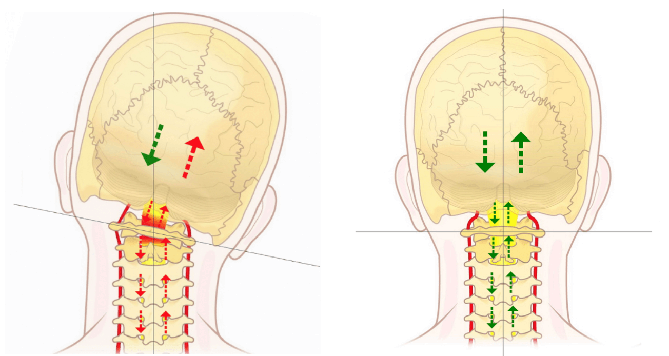 Upper Cervical Spinal Care – Crossroads Brain & Spine